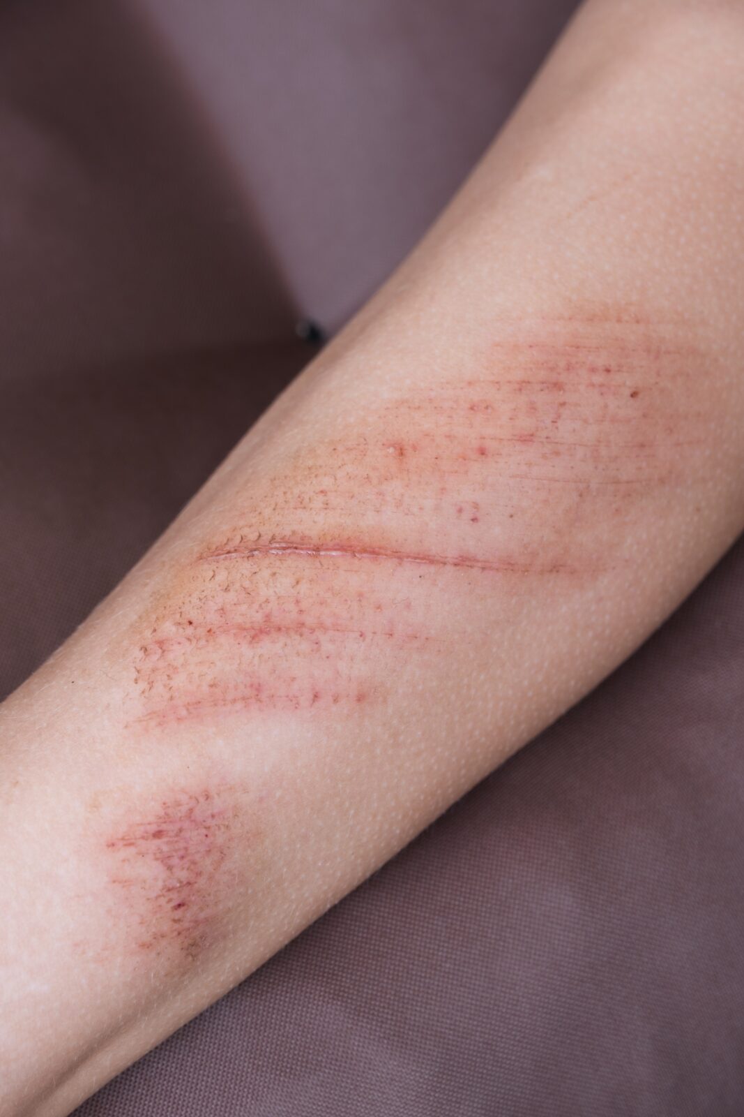 The Truth About Scars: Causes, Treatments and Reduction Methods ...