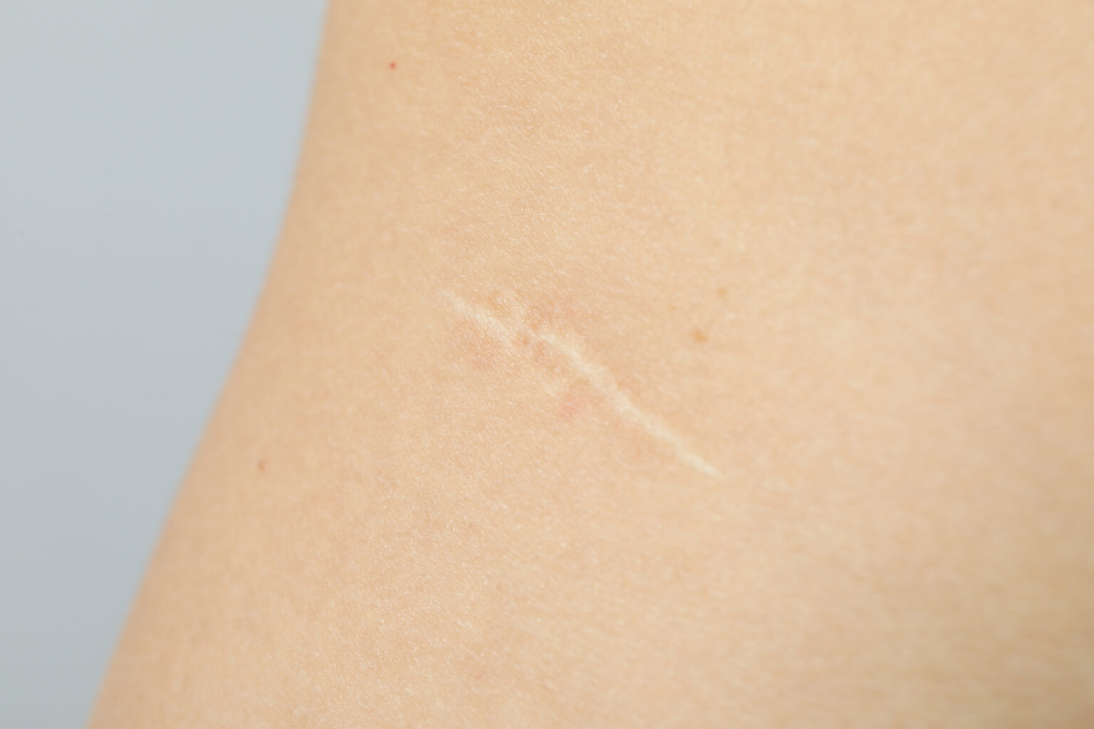 The Truth About Scars: Causes, Treatments and Reduction Methods ...