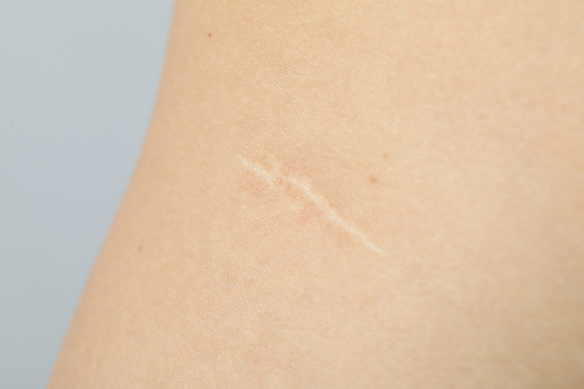 The Truth About Scars: Causes, Treatments and Reduction Methods ...