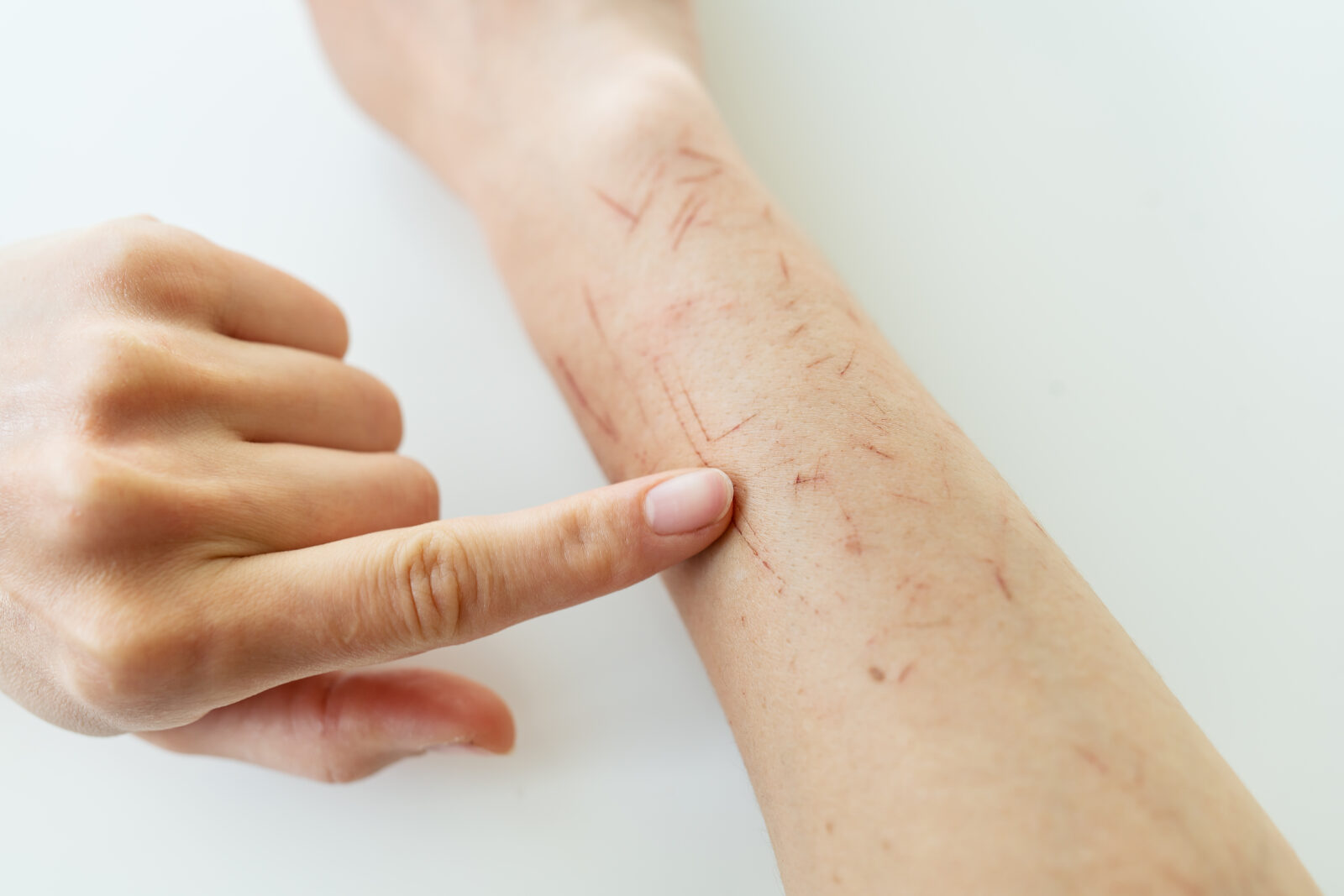 The Truth About Scars: Causes, Treatments and Reduction Methods ...